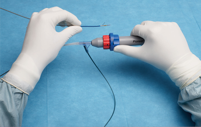 Philips announces the relaunch of its Pioneer Plus catheter, the only ...