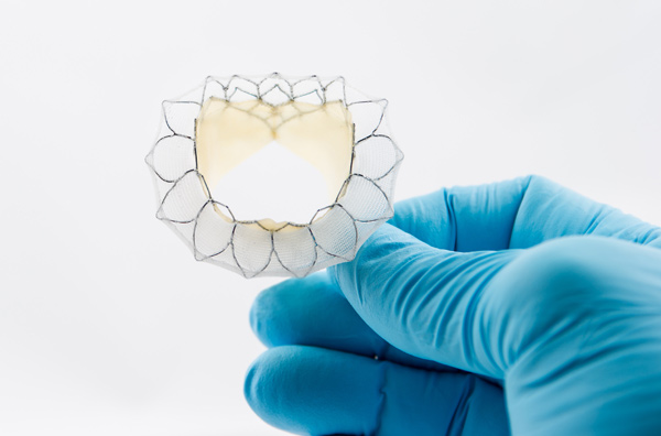 Neovasc Reports Tiara's Clinical Case Load Accelerating - Cardiac ...