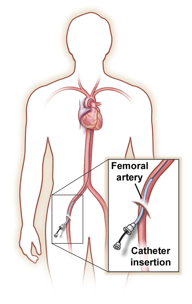 Angiograms and Angioplasty - Using your body's vascular highway to ...