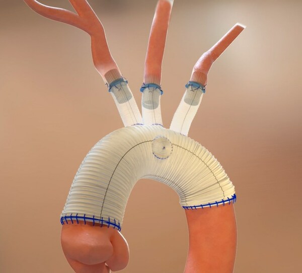 Aquedeon Medical, Inc. Receives FDA IDE Approval for the Duett Vascular ...