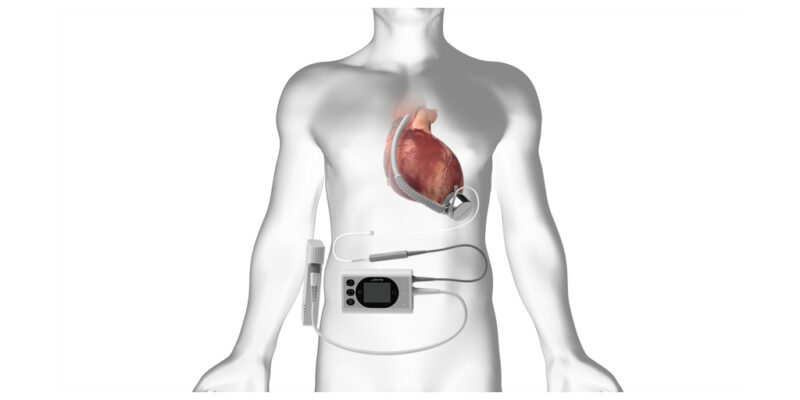 BrioHealth Solutions Begins Patient Enrollment in INNOVATE Trial of ...