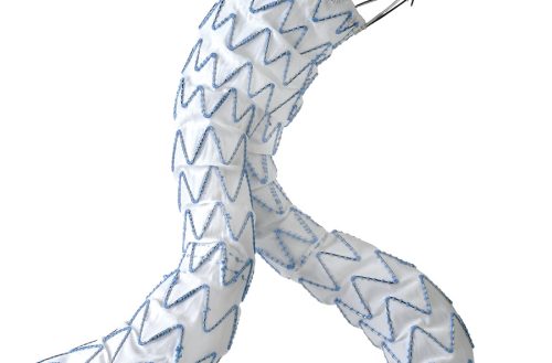 GORE RECEIVES FDA APPROVAL FOR BREAKTHROUGH ENDOVASCULAR DEVICE IN ...