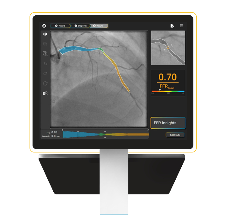 SpectraWAVE Receives 510(k) Clearance for X1™-FFR, an AI-enabled, Wire ...